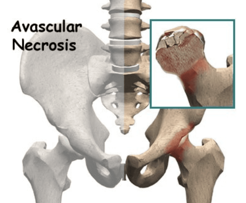Understanding avascular necrosis of the hip | Orthopedic Center for ...
